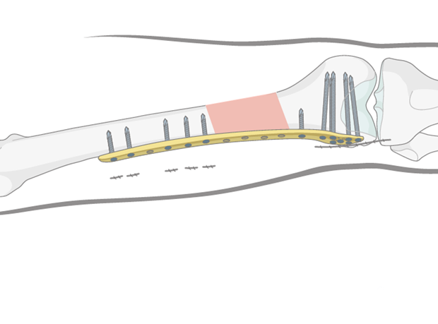 The Ultimate Guide to the Distal Femoral Locking Plate - CZMEDITECH