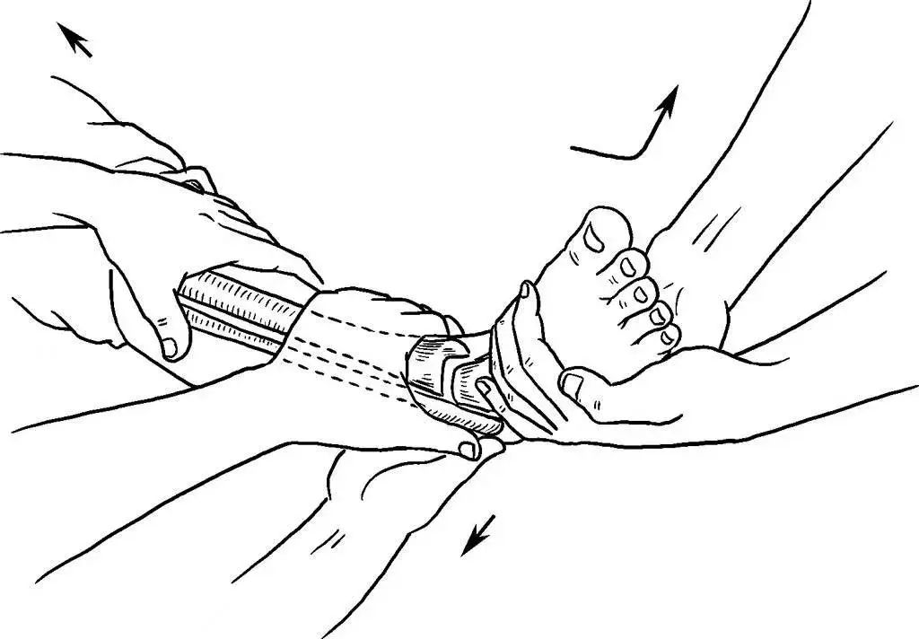 Closed reduction surgery for lower extremity fractures - CZMEDITECH