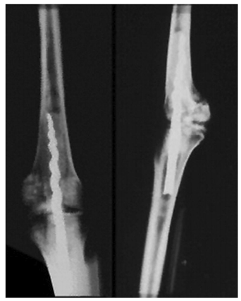 Do you know the history of intramedullary nailing? - CZMEDITECH