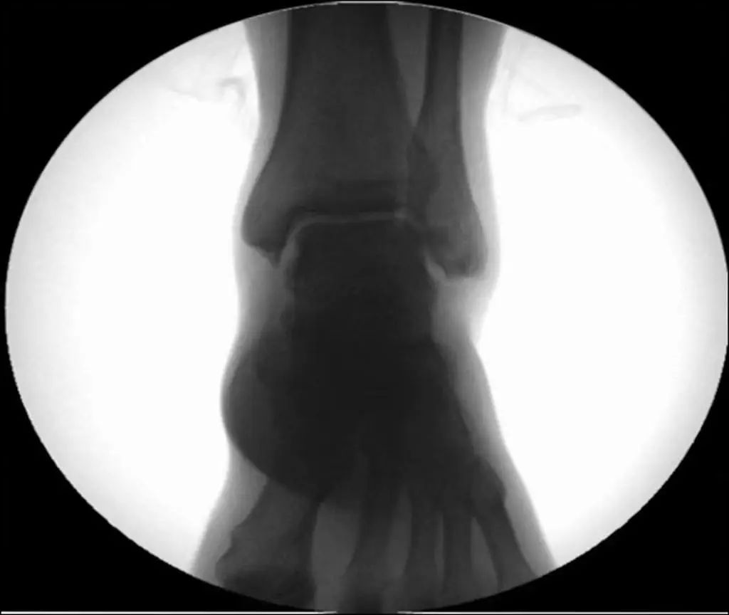 Closed reduction surgery for lower extremity fractures - CZMEDITECH